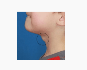 Cirujano general nos explica en qué consiste el quiste tirogloso y cómo ...