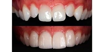 Carillas inyectadas Una excelente alternativa para la estética dental ...