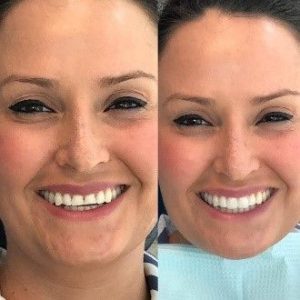 Carillas inyectadas Una excelente alternativa para la estética dental ...